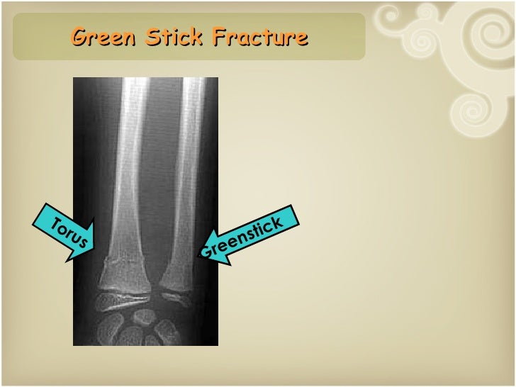 Paediatric fracture
