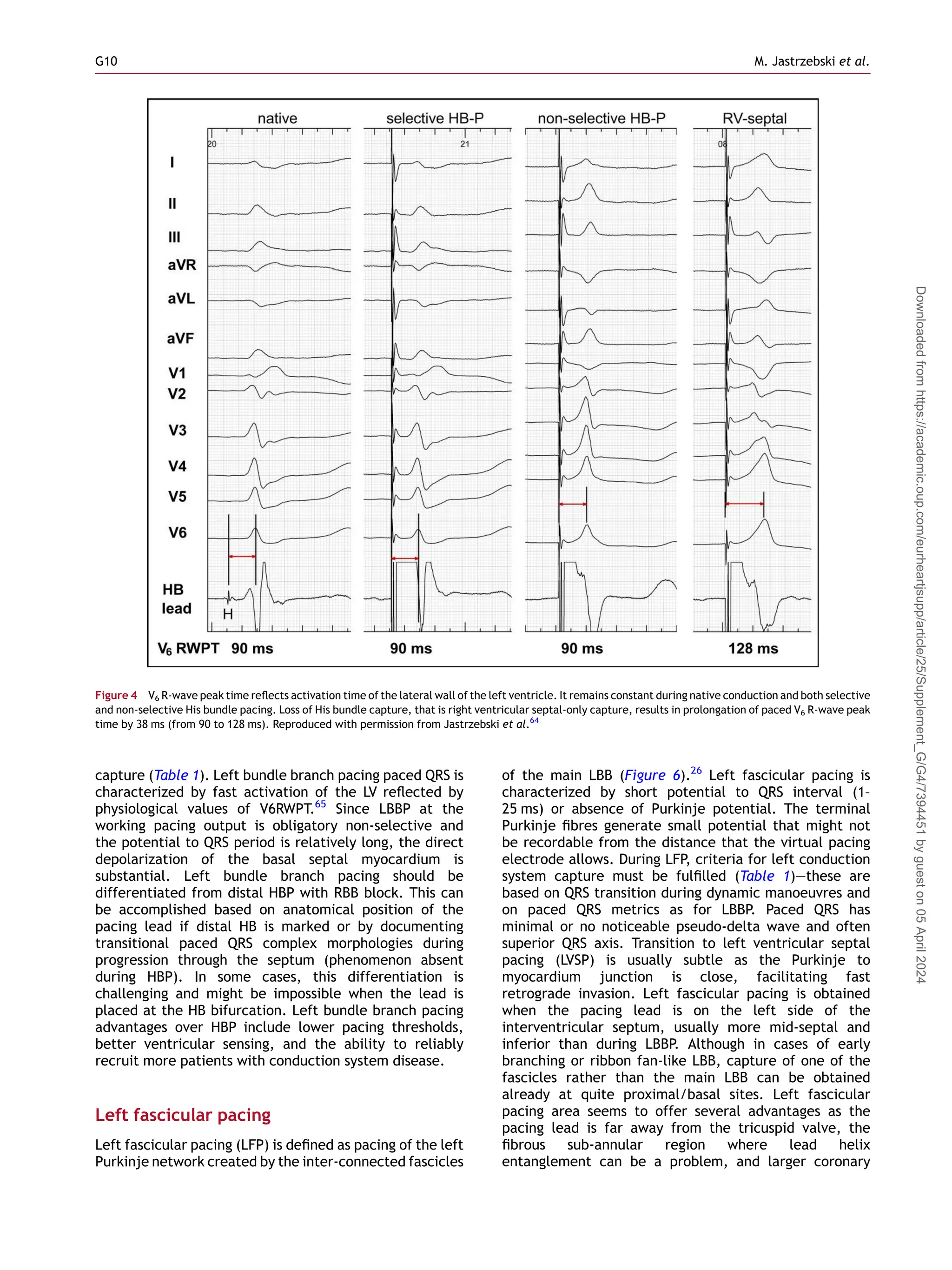 suad114.pdf pacing conduction system pacing | PDF