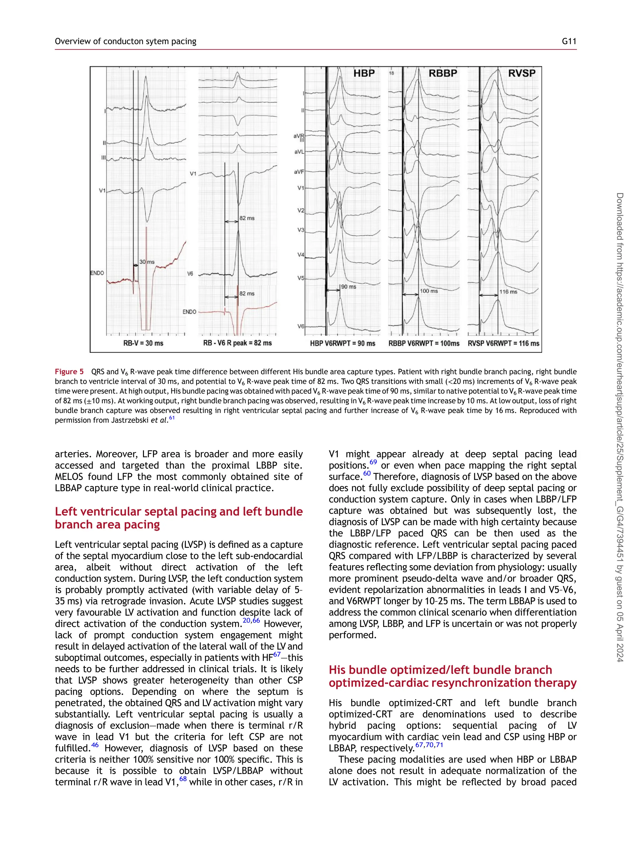 suad114.pdf pacing conduction system pacing | PDF
