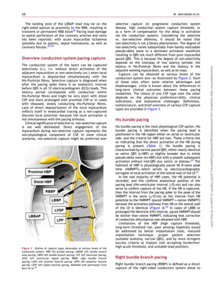 suad114.pdf pacing conduction system pacing | PDF