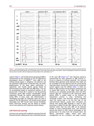 suad114.pdf pacing conduction system pacing | PDF