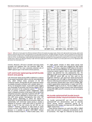 suad114.pdf pacing conduction system pacing | PDF