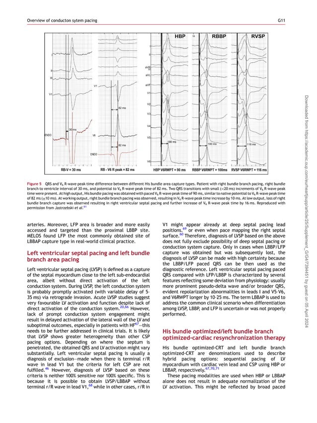 suad114.pdf pacing conduction system pacing | PDF