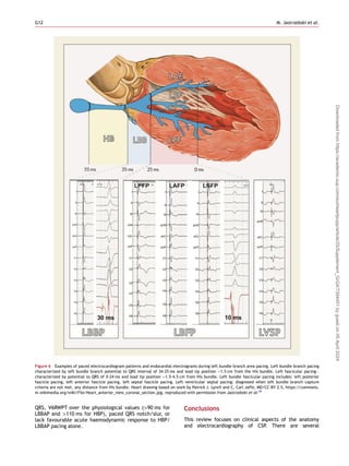suad114.pdf pacing conduction system pacing | PDF