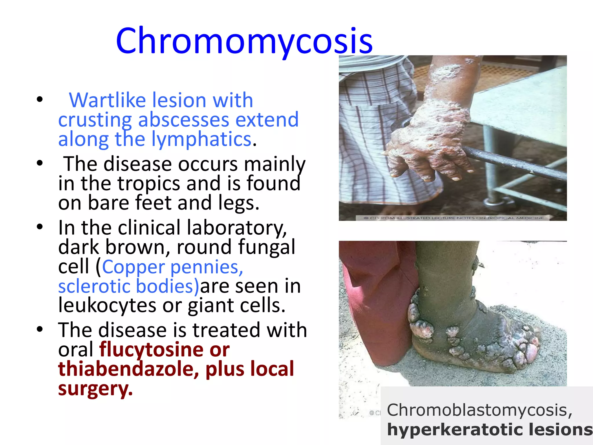 Sub cutaneous fungal infections for mbbs students | PPTX