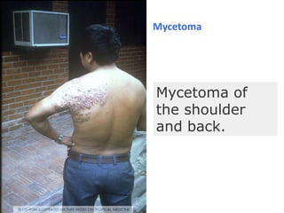 Sub cutaneous fungal infections for mbbs students | PPTX