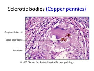 Sub cutaneous fungal infections for mbbs students | PPTX