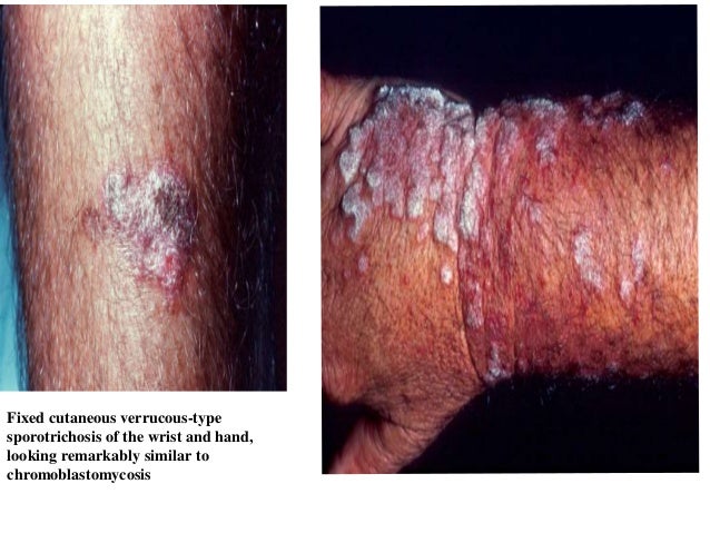 Sub cutaneous fungal infections