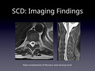 subacute-combined-degeneration-of-spinal-cord.ppt