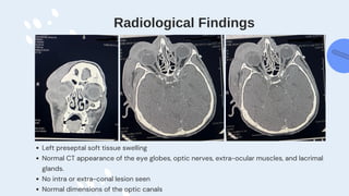 Preseptal cellulitis case presentation.. | PDF