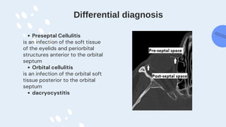 Preseptal cellulitis case presentation.. | PDF