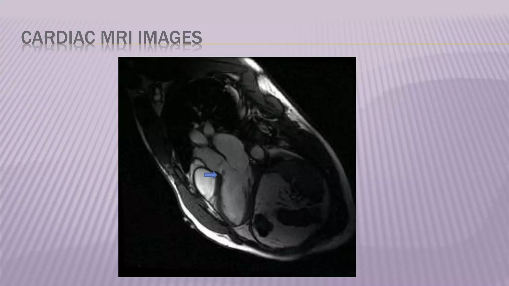 Subaortic membrane | PPTX