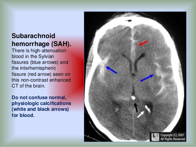 Subarachnoid haemorrhage