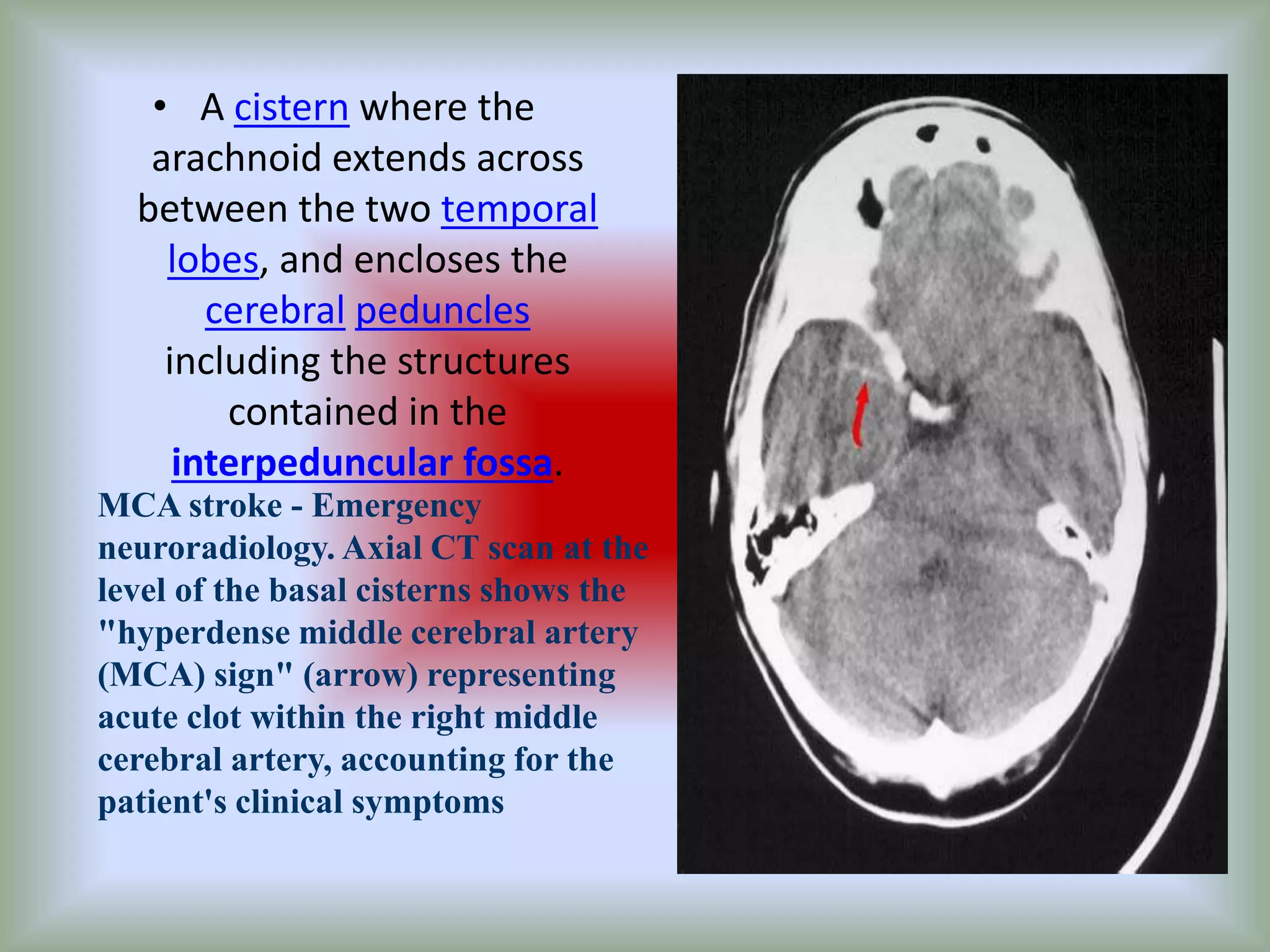 Subarachnoid haemorrhage | PPTX