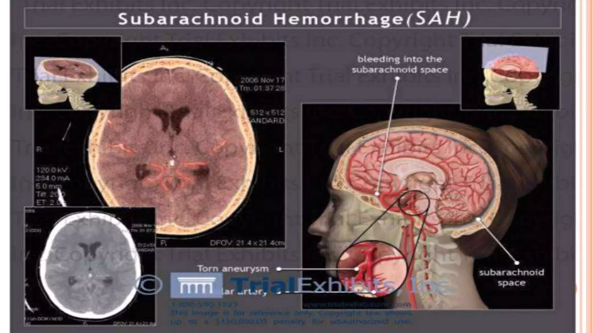 Subarachnoid Haemorrhage(SAH) | PPTX
