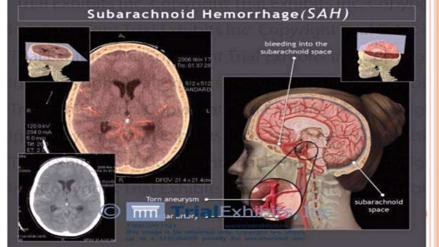 Subarachnoid Haemorrhage(SAH) | PPT