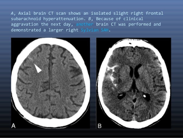 Subarachnoid hemorrhage