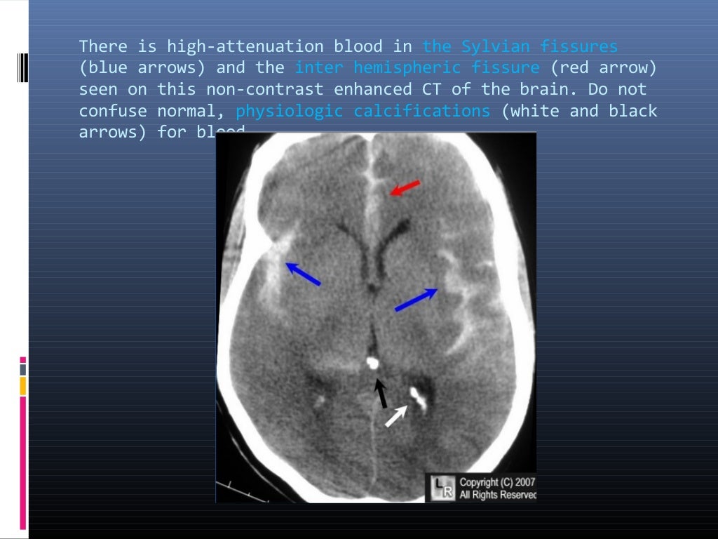 Subarachnoid hemorrhage