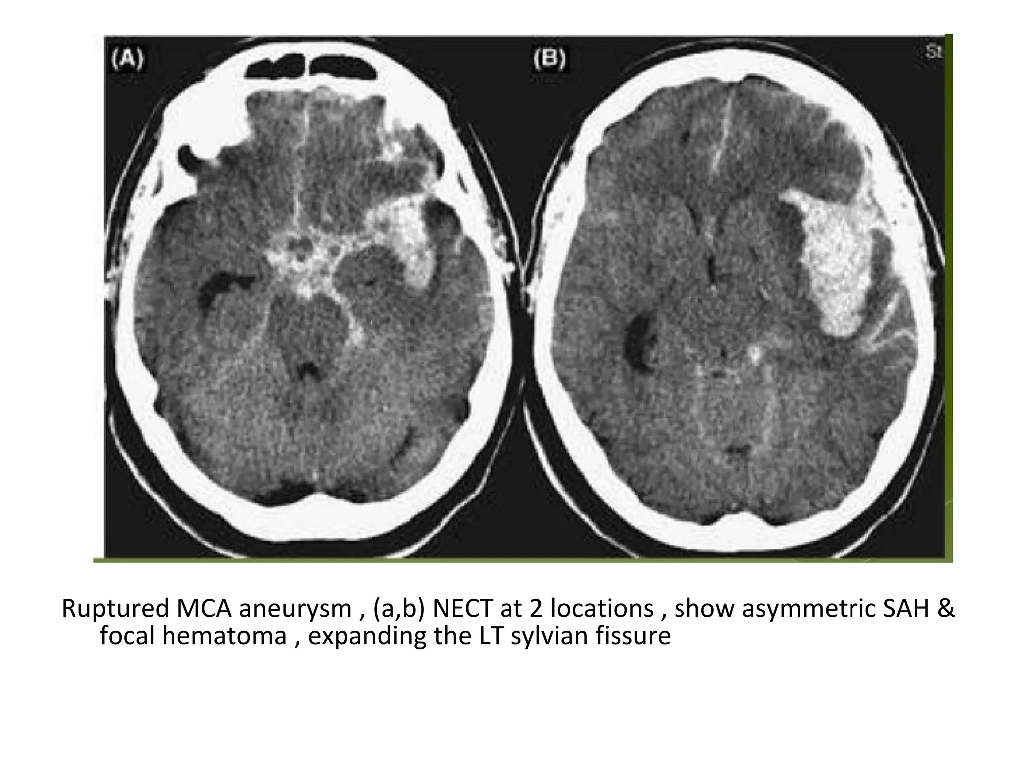 Diagnostic Imaging of Subarachnoid Hemorrhage | PPT