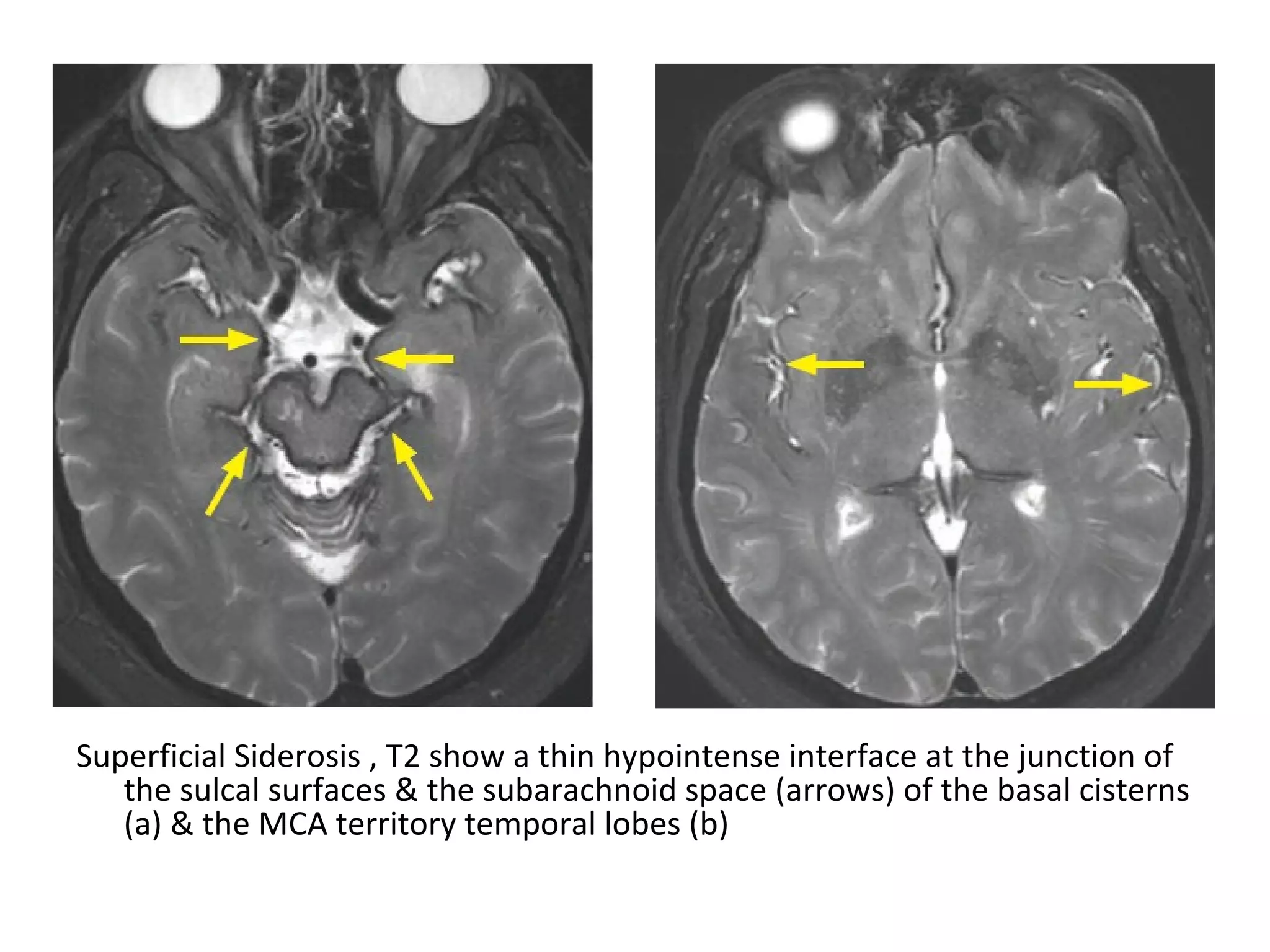 Diagnostic Imaging of Subarachnoid Hemorrhage | PPT