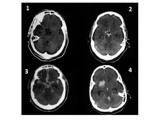 Diagnostic Imaging of Subarachnoid Hemorrhage | PPT