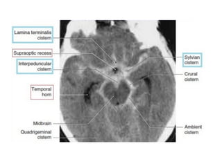 Subarachnoid Space Hemorrhage Ultrasound