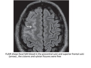 Subarachnoid Hemorrhage Mri