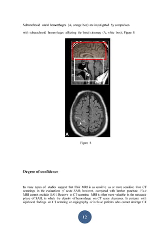 Subarachnoid hemorrhage imaging | DOCX | Blood Disorders | Diseases and Conditions