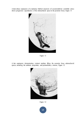 Subarachnoid hemorrhage imaging | DOCX | Blood Disorders | Diseases and Conditions