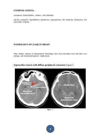 Subarachnoid hemorrhage imaging | DOCX | Blood Disorders | Diseases and Conditions
