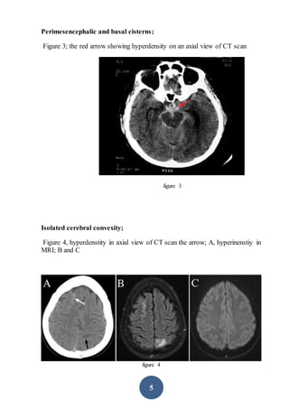 Subarachnoid hemorrhage imaging | DOCX | Blood Disorders | Diseases and Conditions