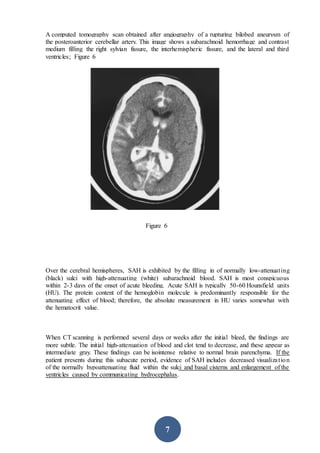 Subarachnoid hemorrhage imaging | DOCX | Blood Disorders | Diseases and Conditions