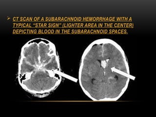 lecture on subarachnoid hemorrhage.pptx.important clues | PPTX