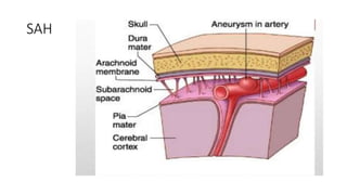 Subarachnoid Hemorrhage (SAH) and Aneurysm presentation.pptx