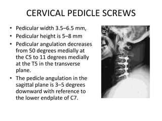 Subaxial cervical fixation techniques | PPTX