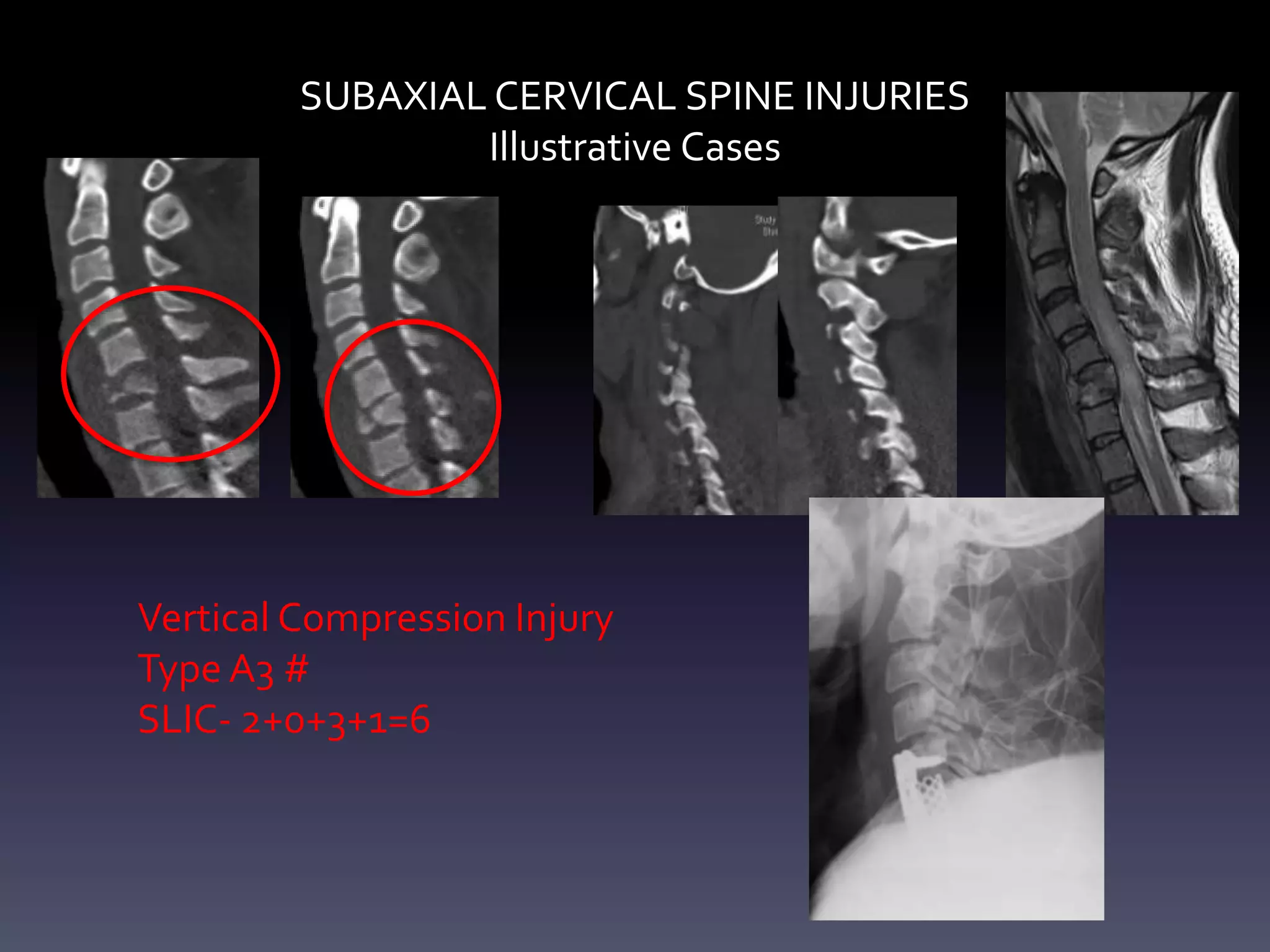 Subaxial cervical spine injuries clinical specturum and emergency ...