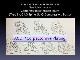 Subaxial cervical spine injuries clinical specturum and emergency ...