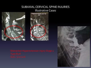 Subaxial cervical spine injuries clinical specturum and emergency ...