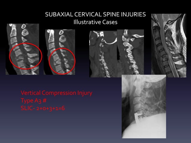 Subaxial cervical spine injuries clinical specturum and emergency ...