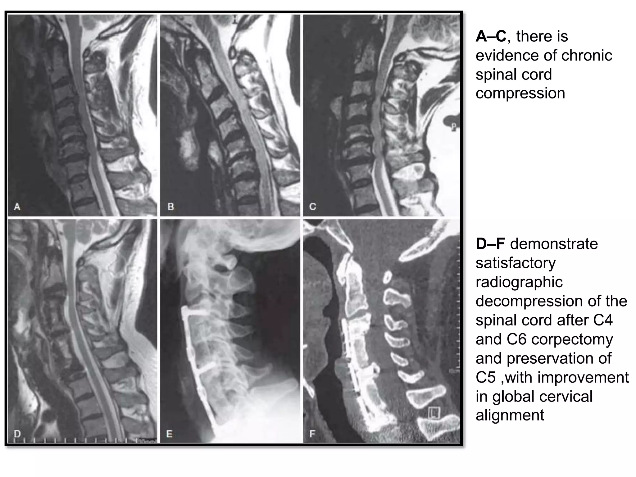 Subaxial Cervical spine fusion.pptx
