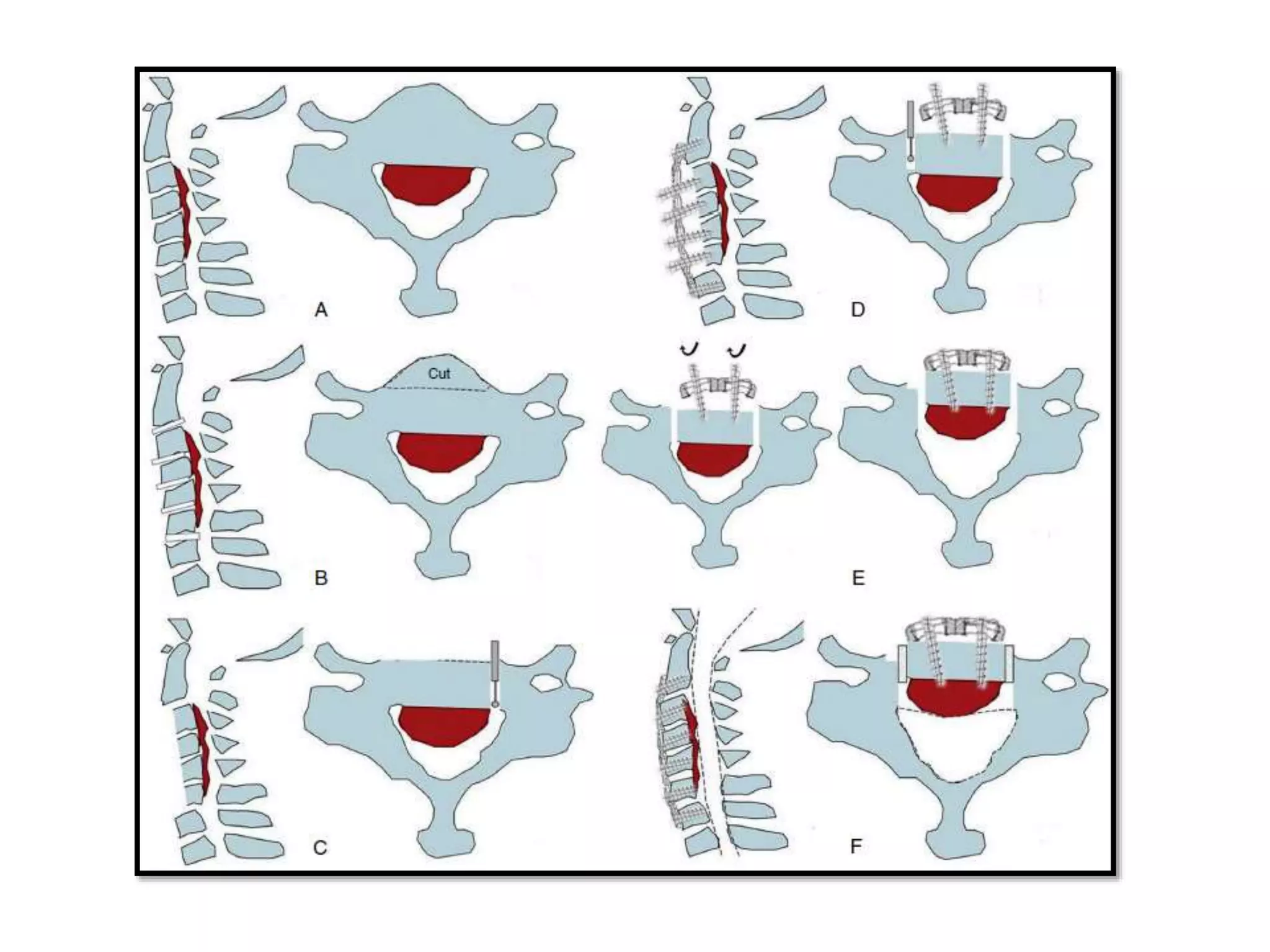 Subaxial Cervical spine fusion.pptx