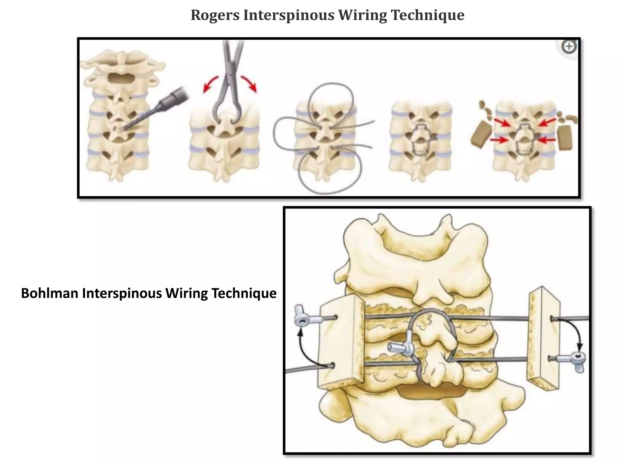Subaxial Cervical spine fusion.pptx