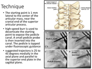 Subaxial Cervical spine fusion.pptx
