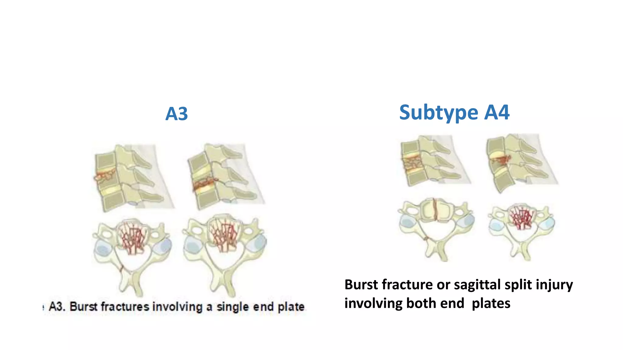 Subaxial spine | PPTX