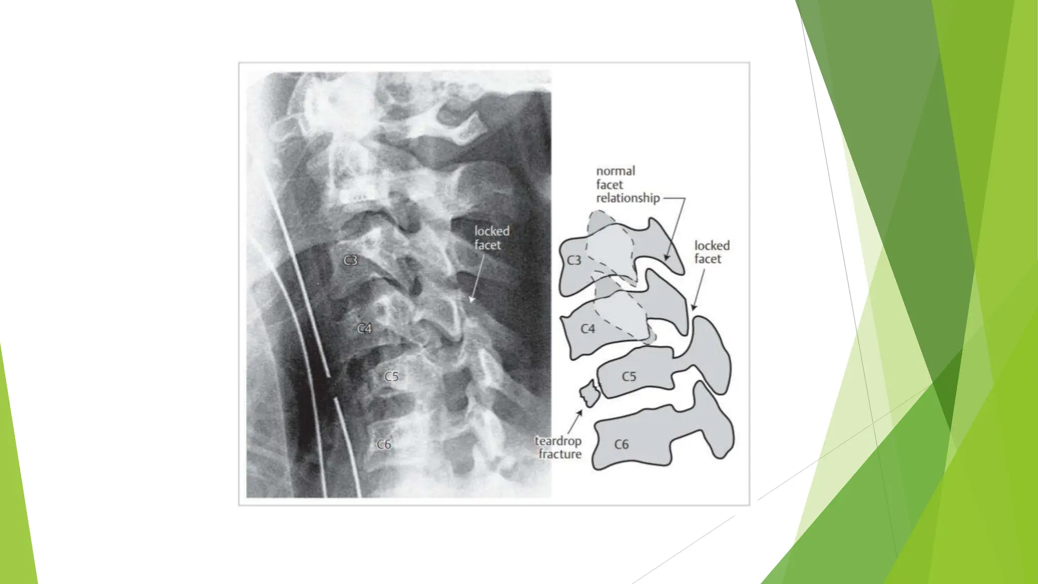 Sub Axial Cervical Spine Trauma and its classification | PPTX