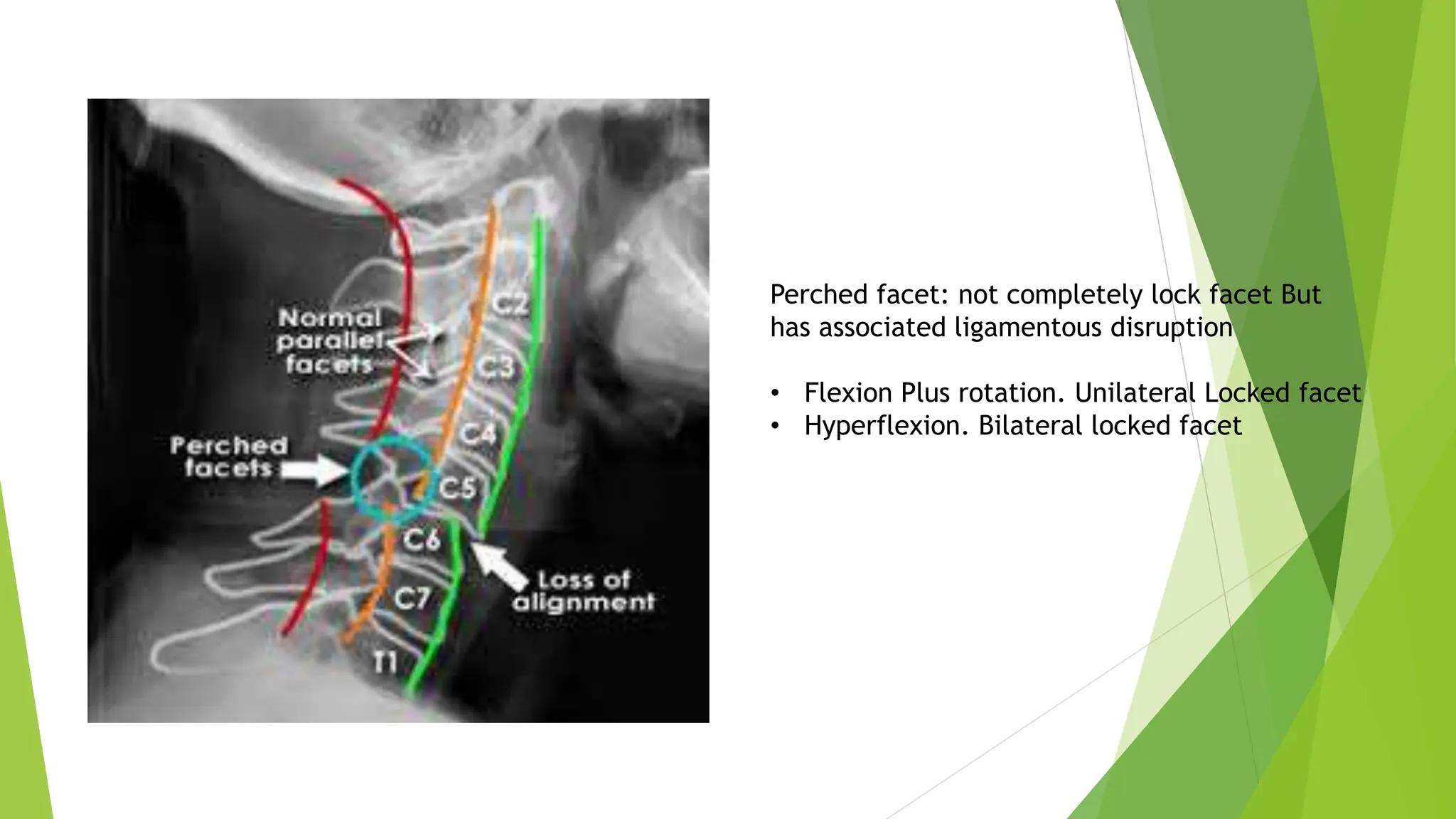 Sub Axial Cervical Spine Trauma and its classification | PPTX | Death ...