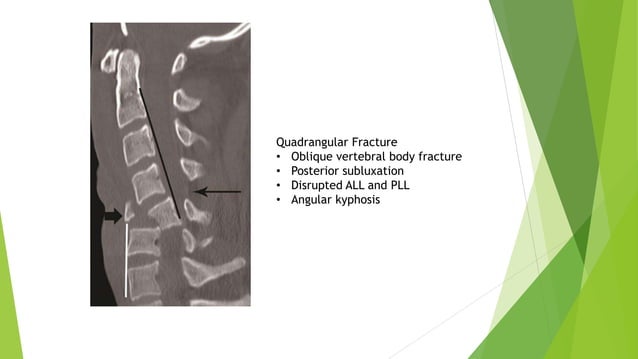 Sub Axial Cervical Spine Trauma and its classification | PPT