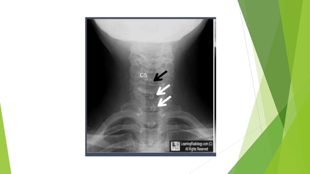 Sub Axial Cervical Spine Trauma and its classification | PPT