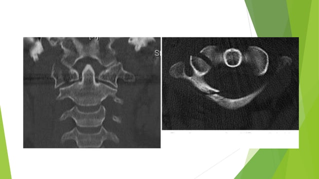 Sub Axial Cervical Spine Trauma and its classification | PPT