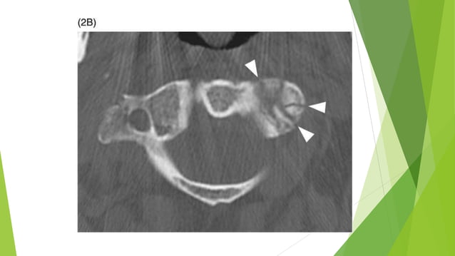 Sub Axial Cervical Spine Trauma and its classification | PPT